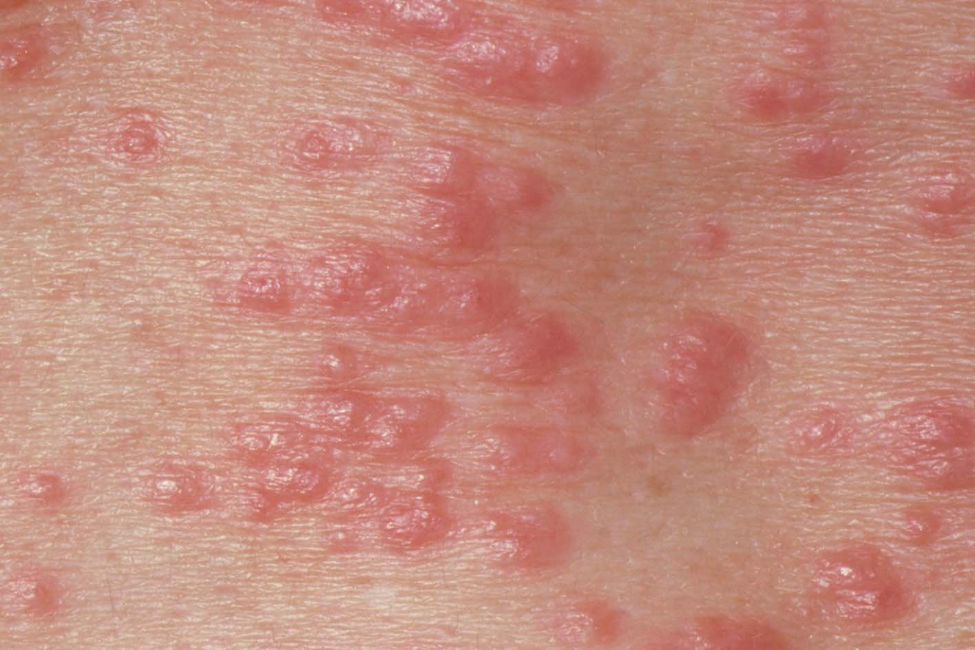 Scabies Rash On Face